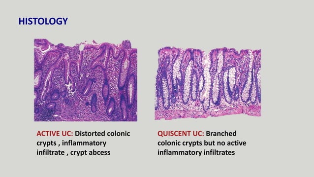 ULCERATIVE COLITIS MANAGEMENT | PPTX | Digestive Disorders | Diseases ...