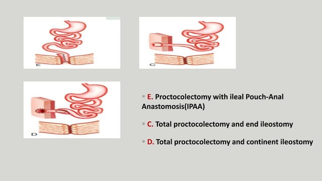ULCERATIVE COLITIS MANAGEMENT | PPTX | Digestive Disorders | Diseases ...