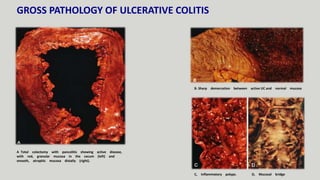 ULCERATIVE COLITIS MANAGEMENT | PPTX