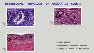ULCERATIVE COLITIS MANAGEMENT | PPTX