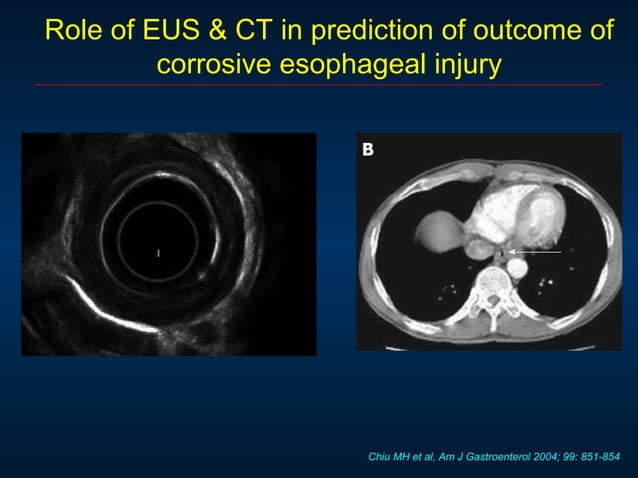 Corrosive esophageal injury | PPT
