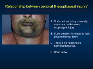 Corrosive esophageal injury | PPT