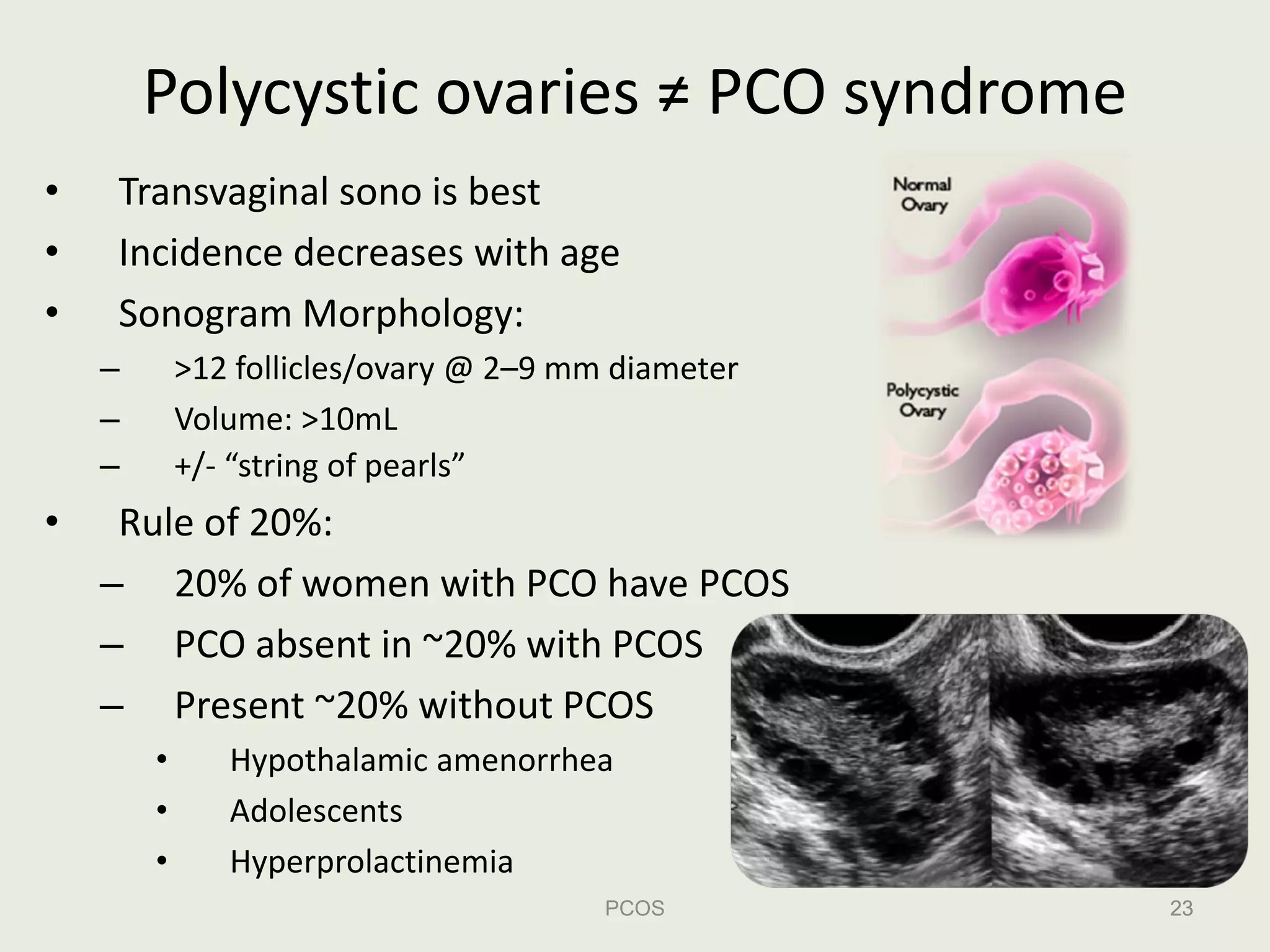 Polycystic Ovary Syndrome (PCOS) | PDF