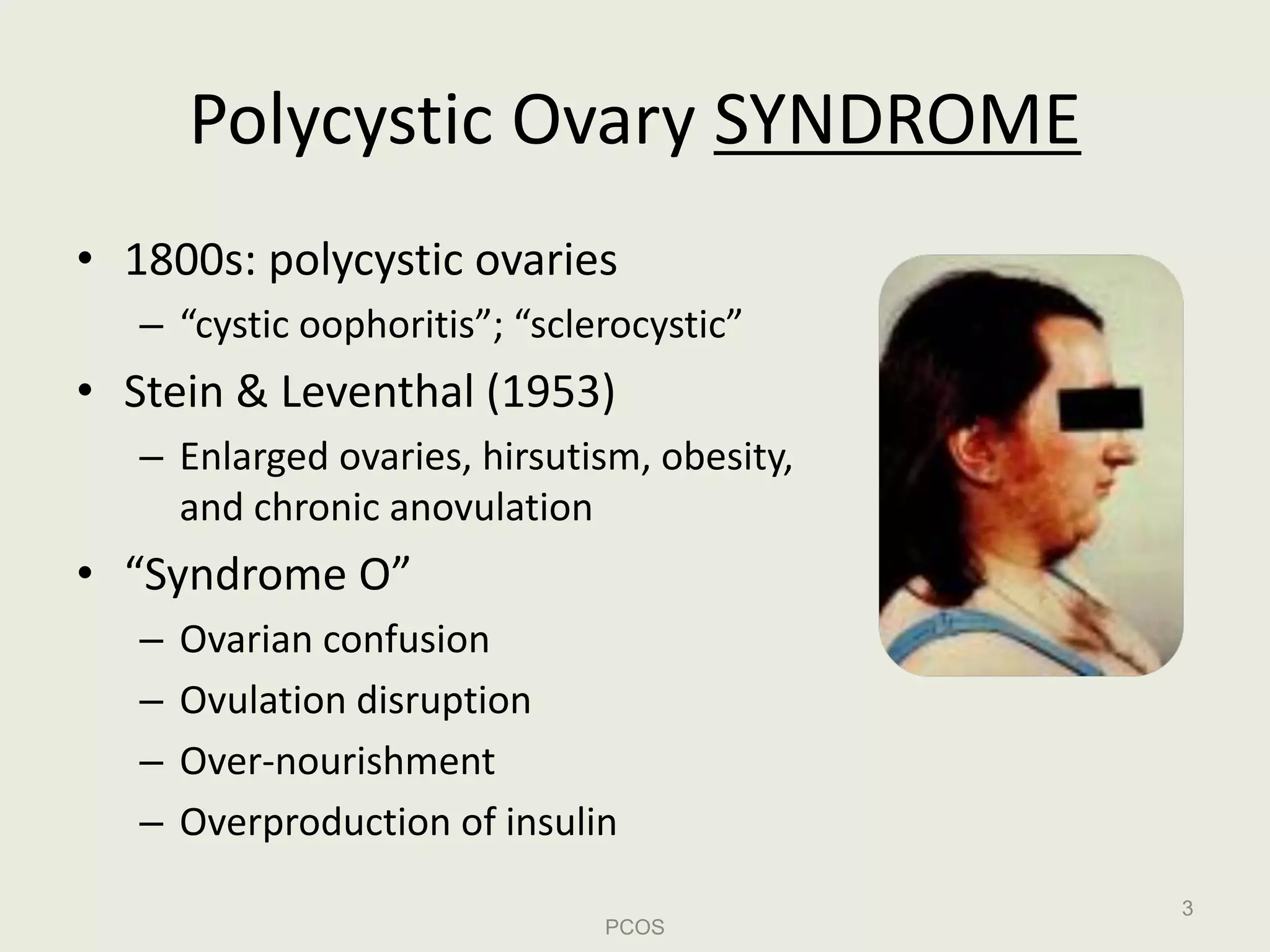 Polycystic Ovary Syndrome (PCOS) | PDF