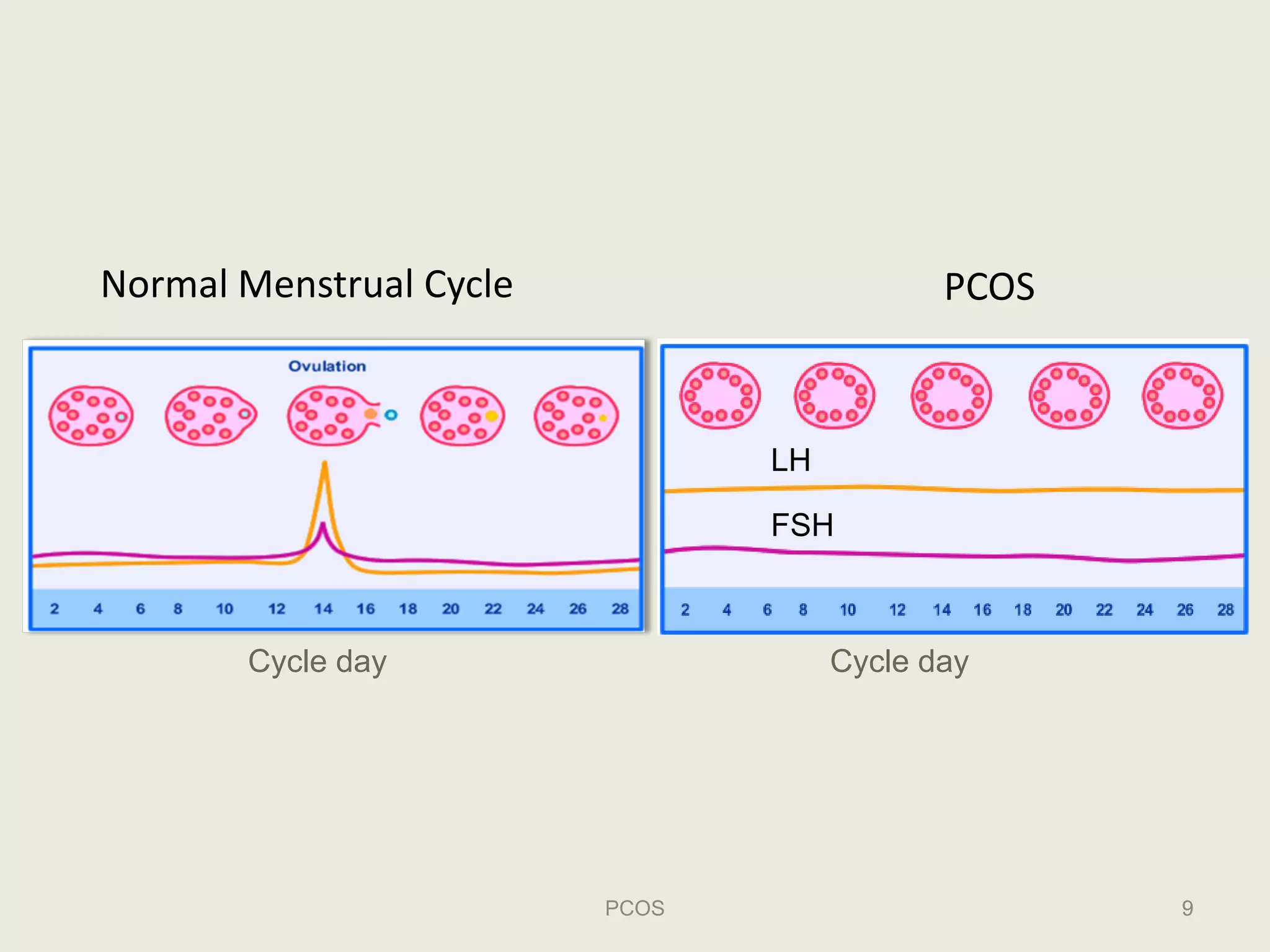 Polycystic Ovary Syndrome (PCOS) | PDF