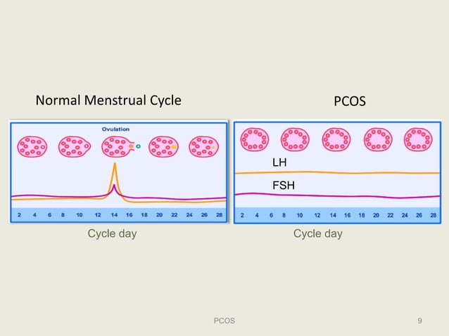 Polycystic Ovary Syndrome (PCOS) | PDF