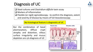 Ulcerative colitis protocol presentation | PPTX