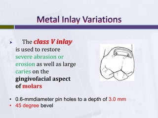 preparations for intracoronal restorations ghasemi | PPT