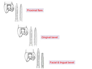 preparations for intracoronal restorations ghasemi | PPT