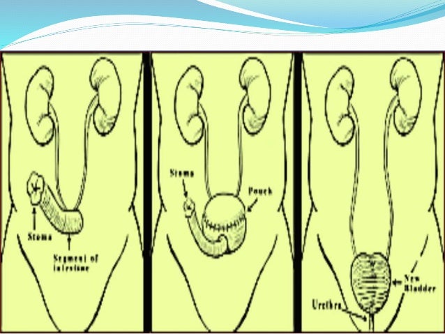 Urinary diversion by dr burhan kaydawla