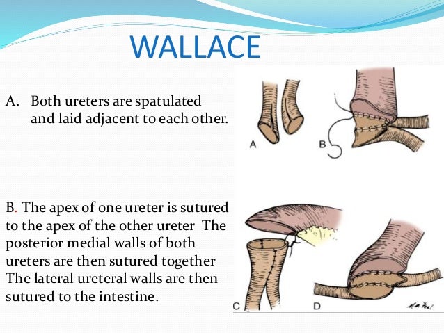 Urinary diversion by dr burhan kaydawla