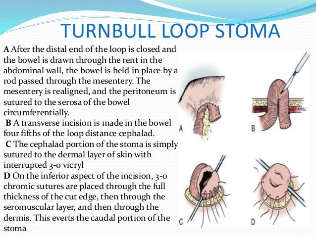 Urinary diversion by dr burhan kaydawla