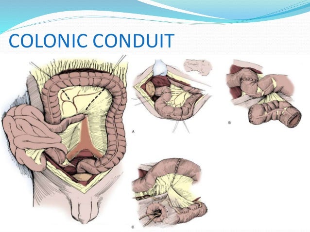 Urinary diversion by dr burhan kaydawla
