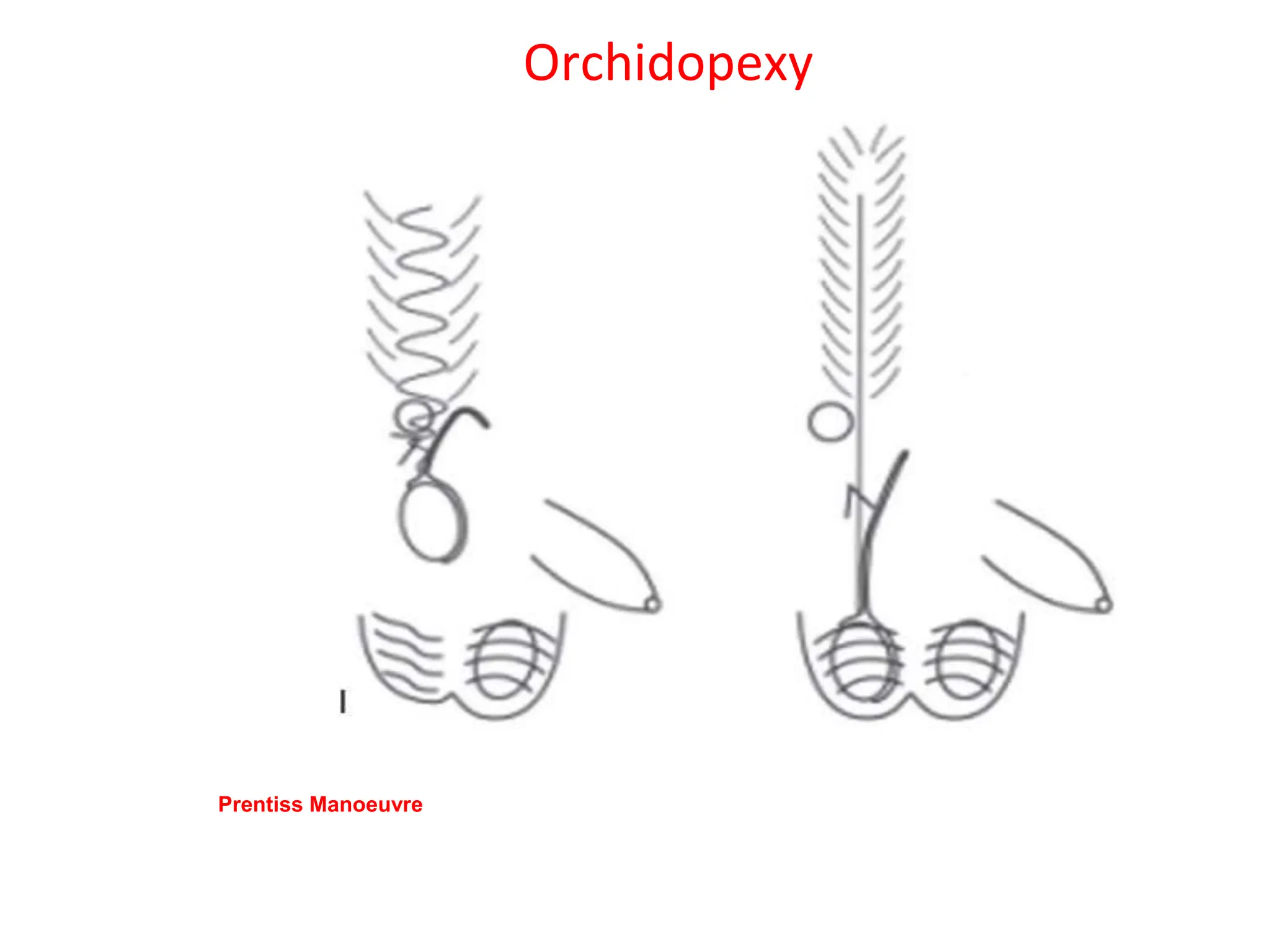 Undescended Testis Basics and Advanced.pptx