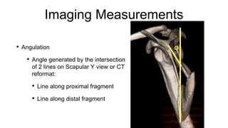 Scapula Fractures classification and manegment | PDF