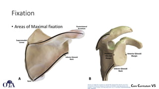 Scapula Fractures classification and manegment | PDF