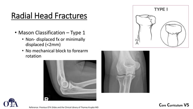 UE 9 Radial Head and Neck Fractures. pdf | PDF