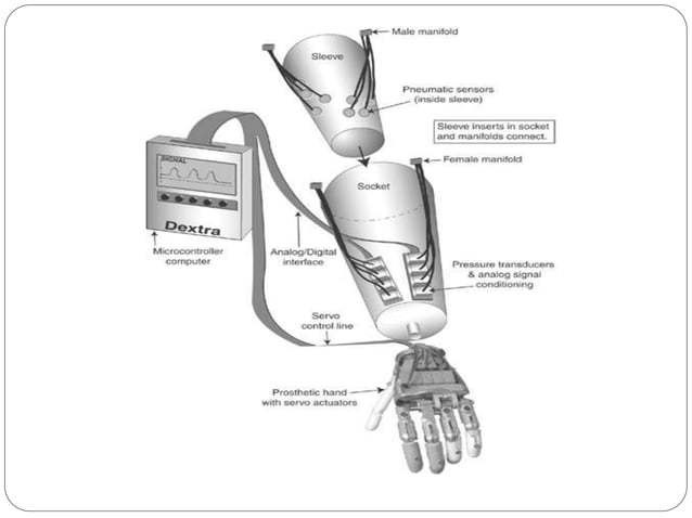 Rehabilitation of Upper Limb Amputee | PPTX | Physical Therapy | Wellness