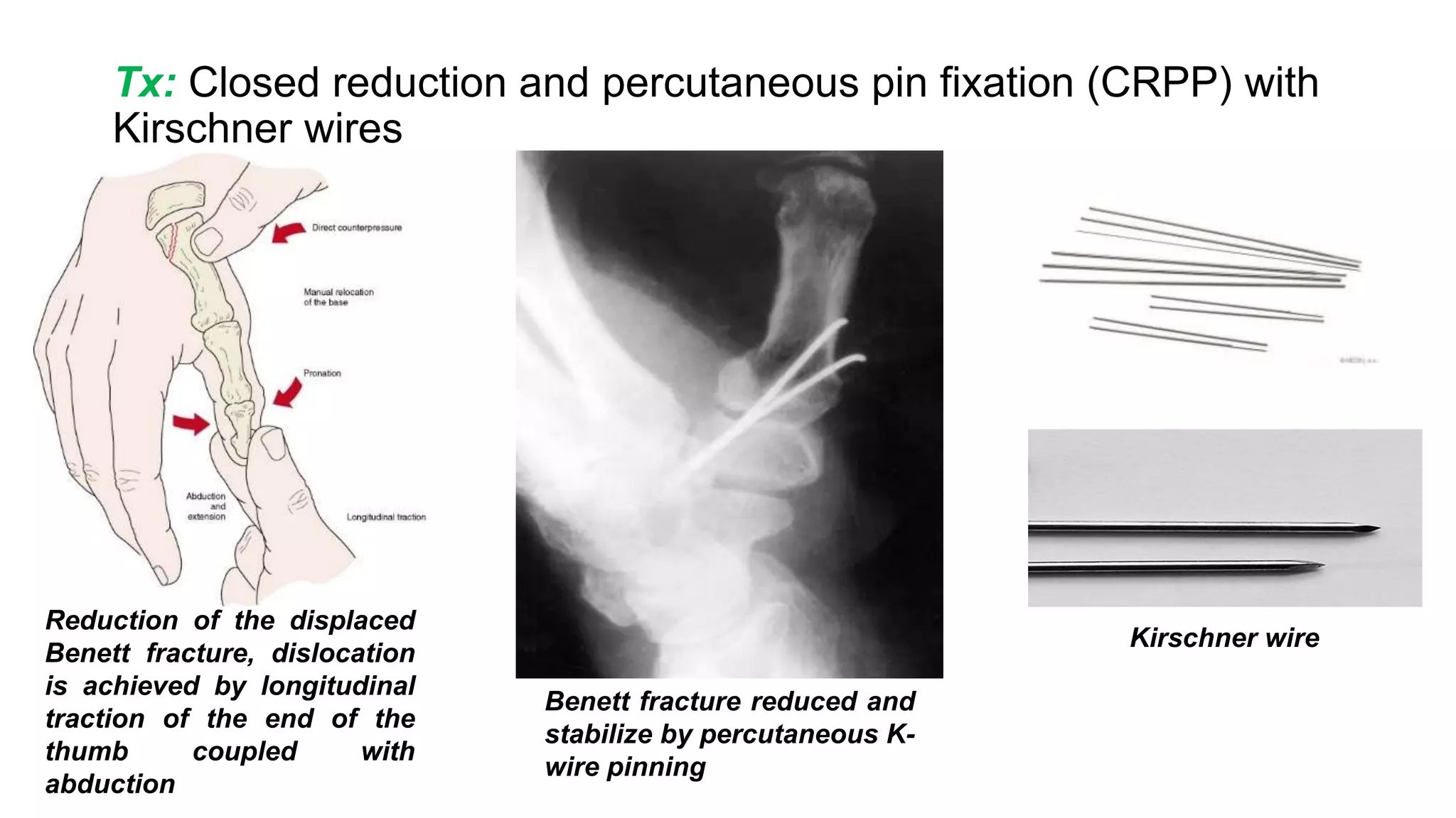 Upper and Lower Extremity fractures | PPTX