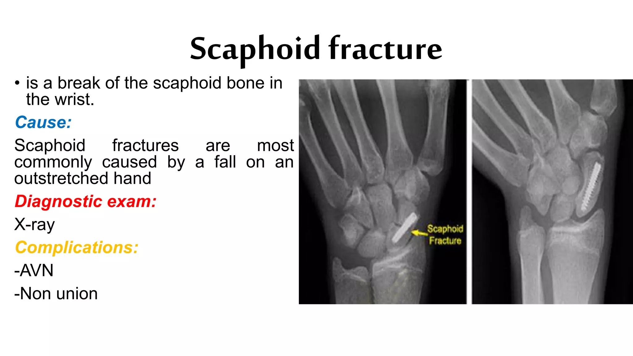 Upper and Lower Extremity fractures | PPTX