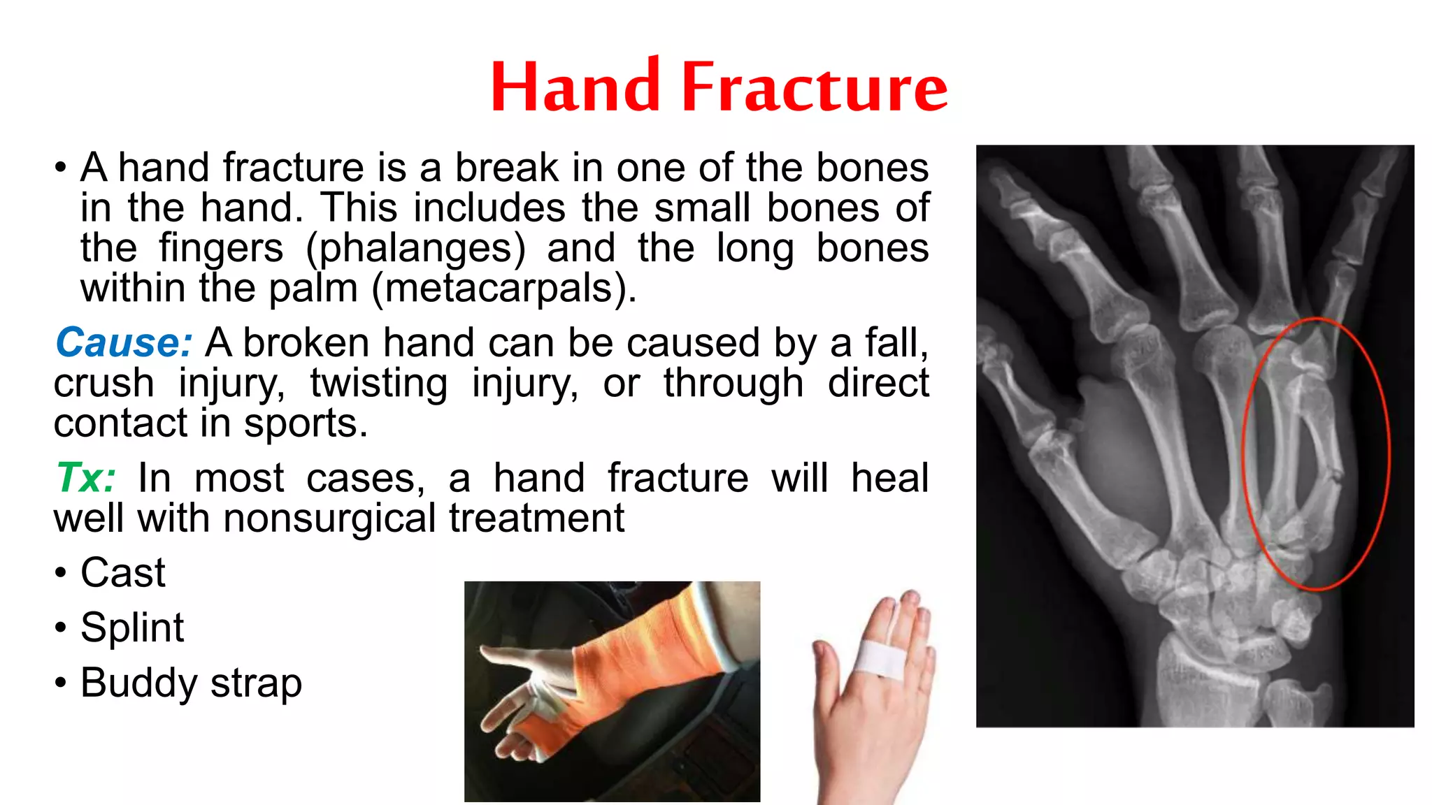 Upper and Lower Extremity fractures | PPTX