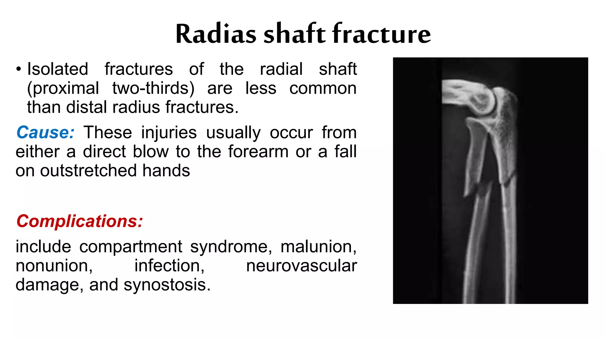 Upper and Lower Extremity fractures | PPTX