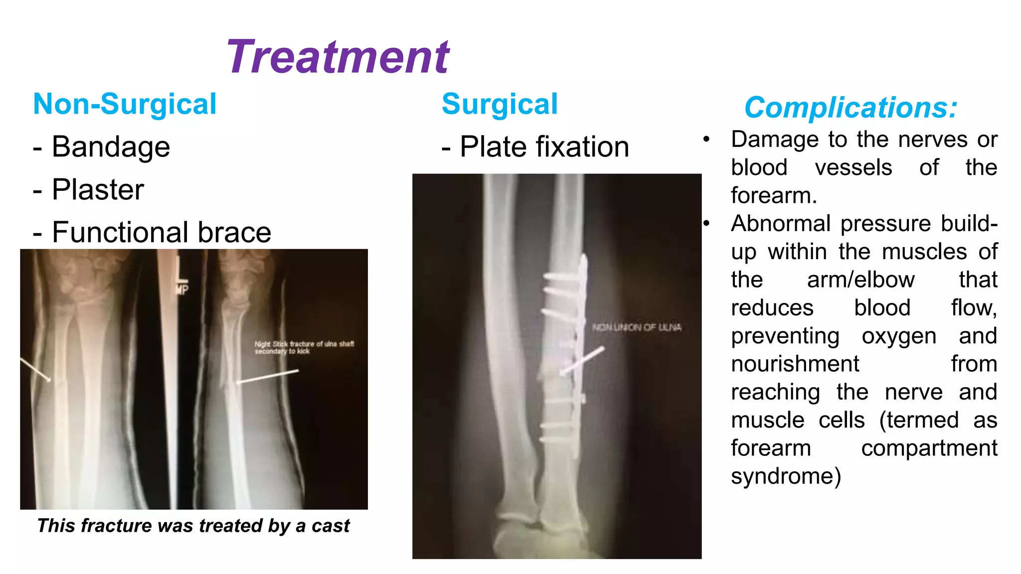 Upper and Lower Extremity fractures | PPTX