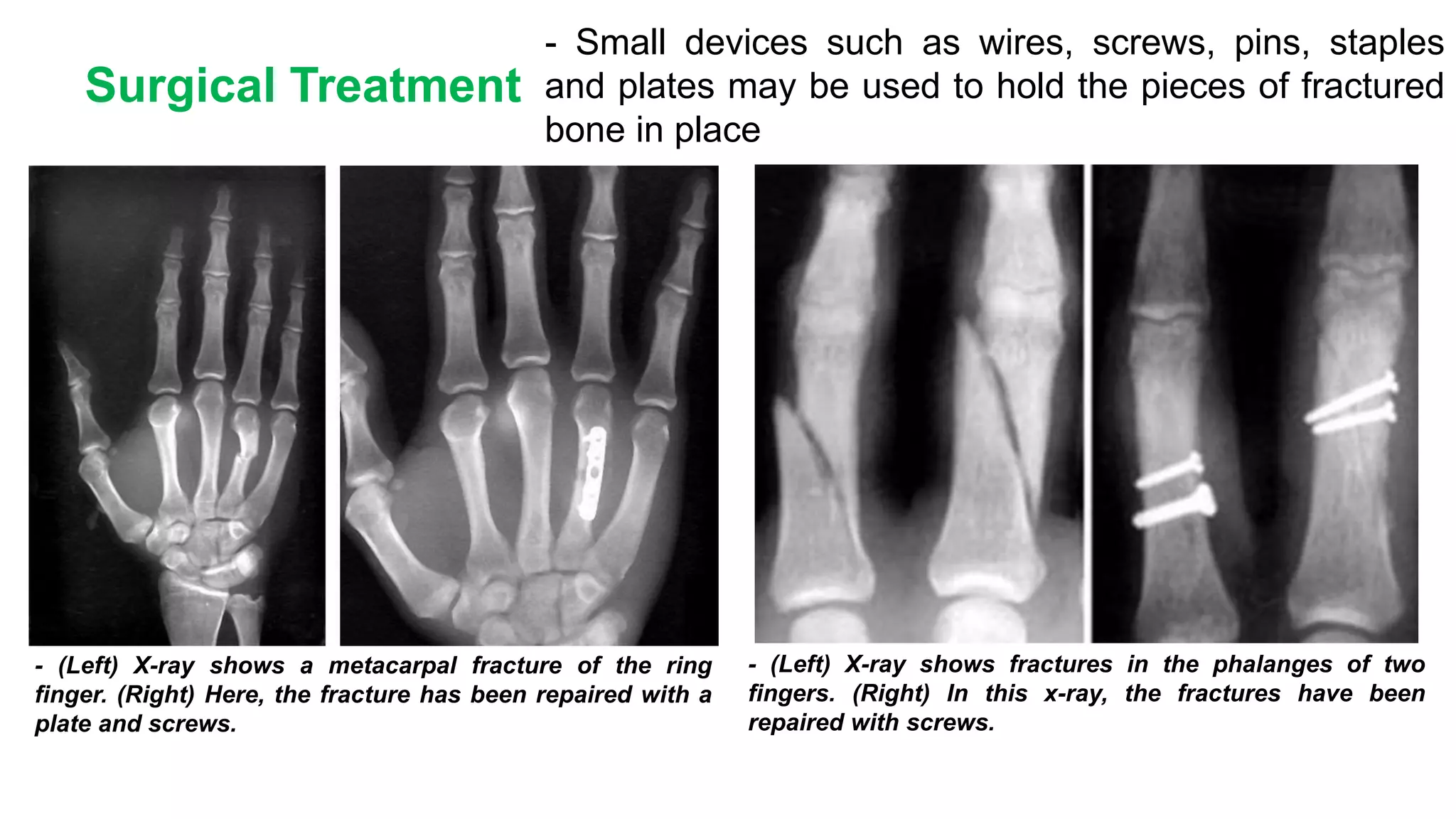 Upper and Lower Extremity fractures | PPTX