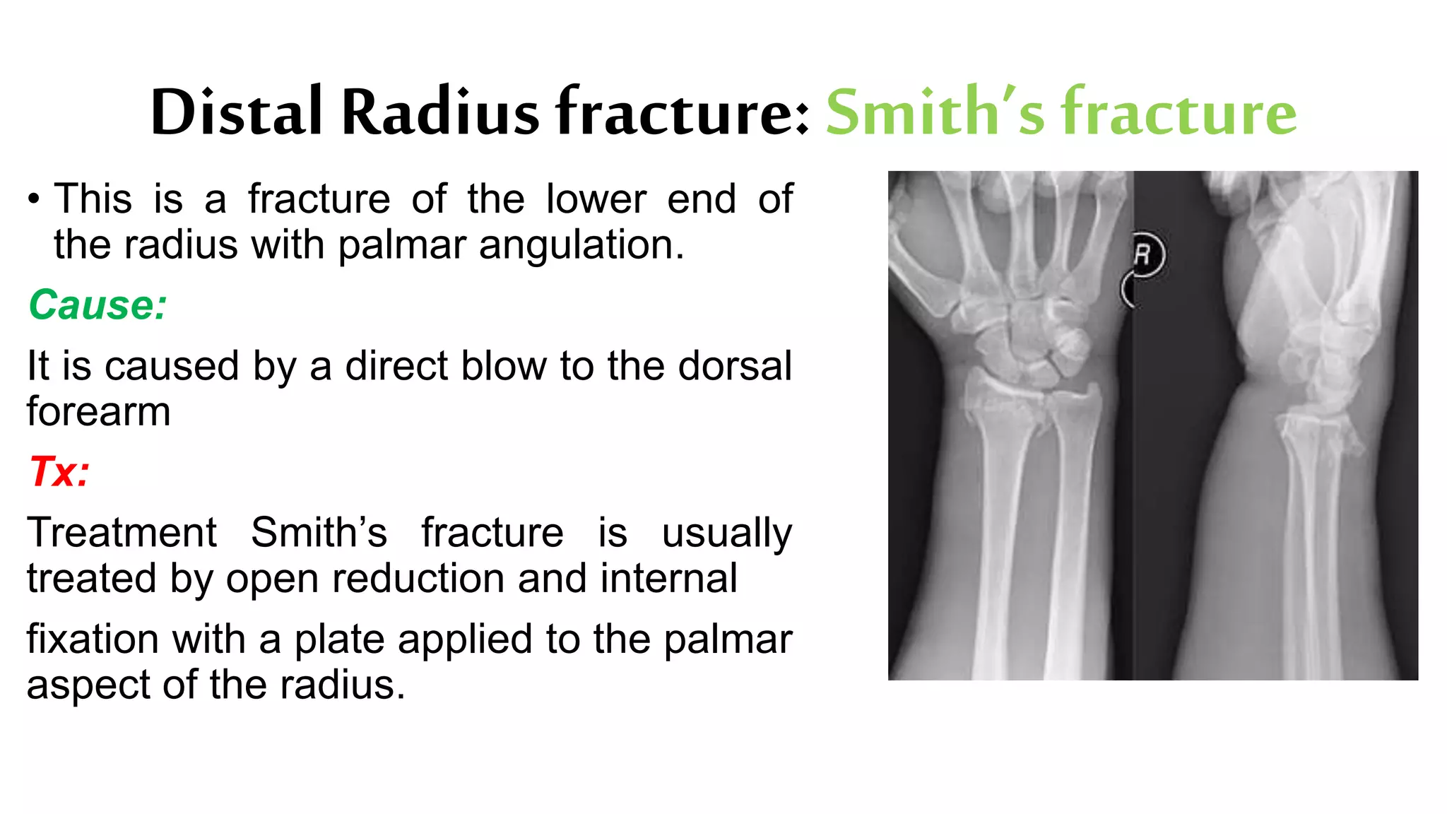 Upper and Lower Extremity fractures | PPTX
