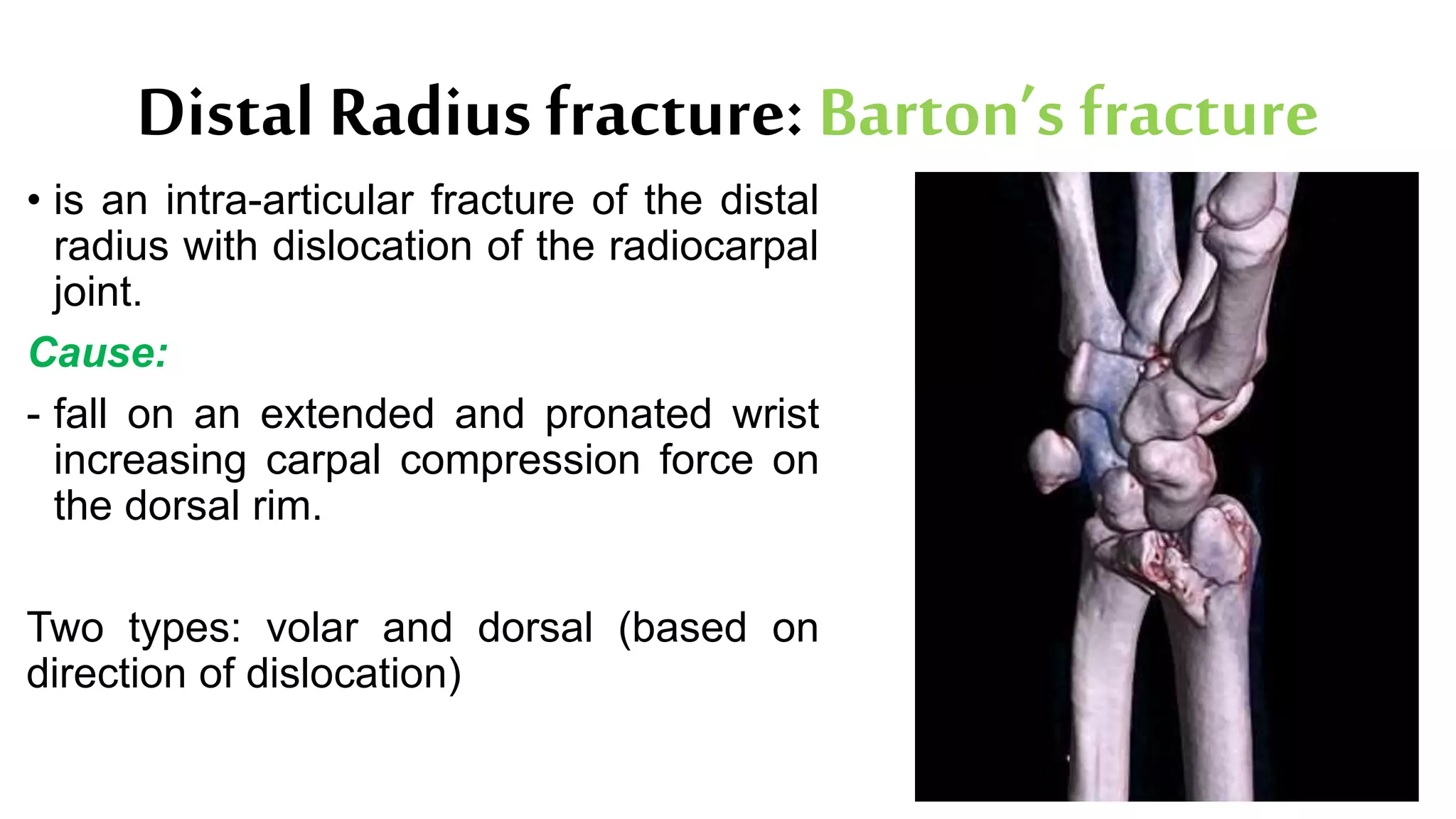Upper and Lower Extremity fractures | PPTX