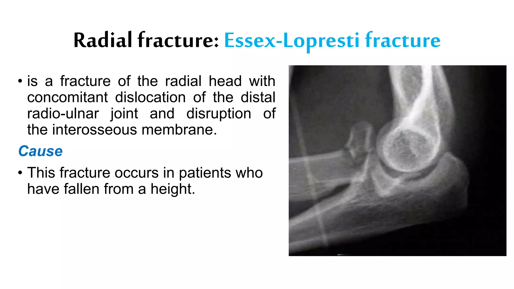 Upper and Lower Extremity fractures | PPTX