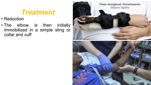 Upper and Lower Extremity fractures | PPTX