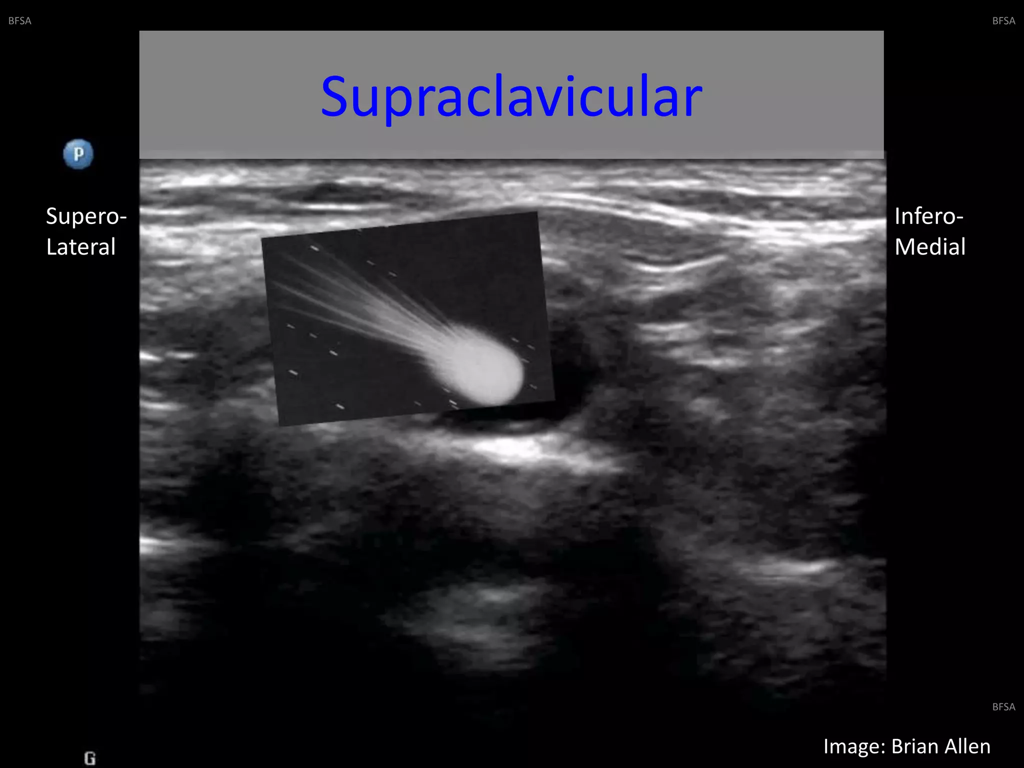 Upper Extremity Regional Anesthesia | PPTX