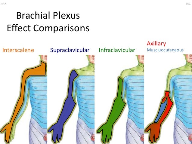 Upper Extremity Regional Anesthesia
