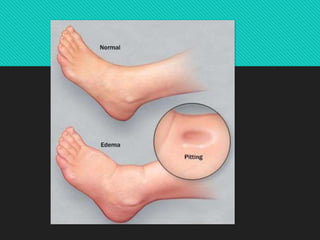 Oedema and hyperemia | PPTX