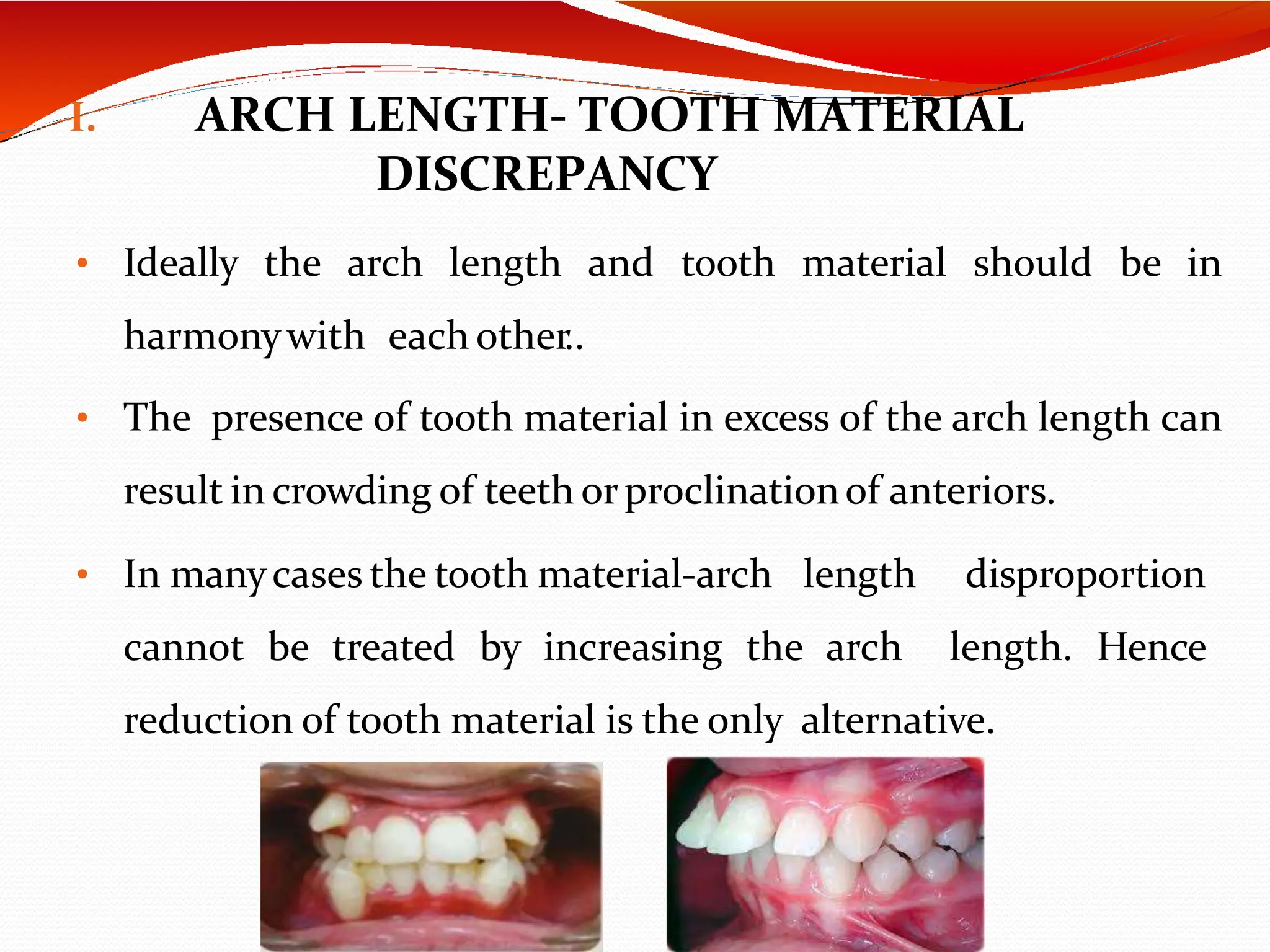 UG CLASS EXTRACTION IN ORTHODONTICS.pptx