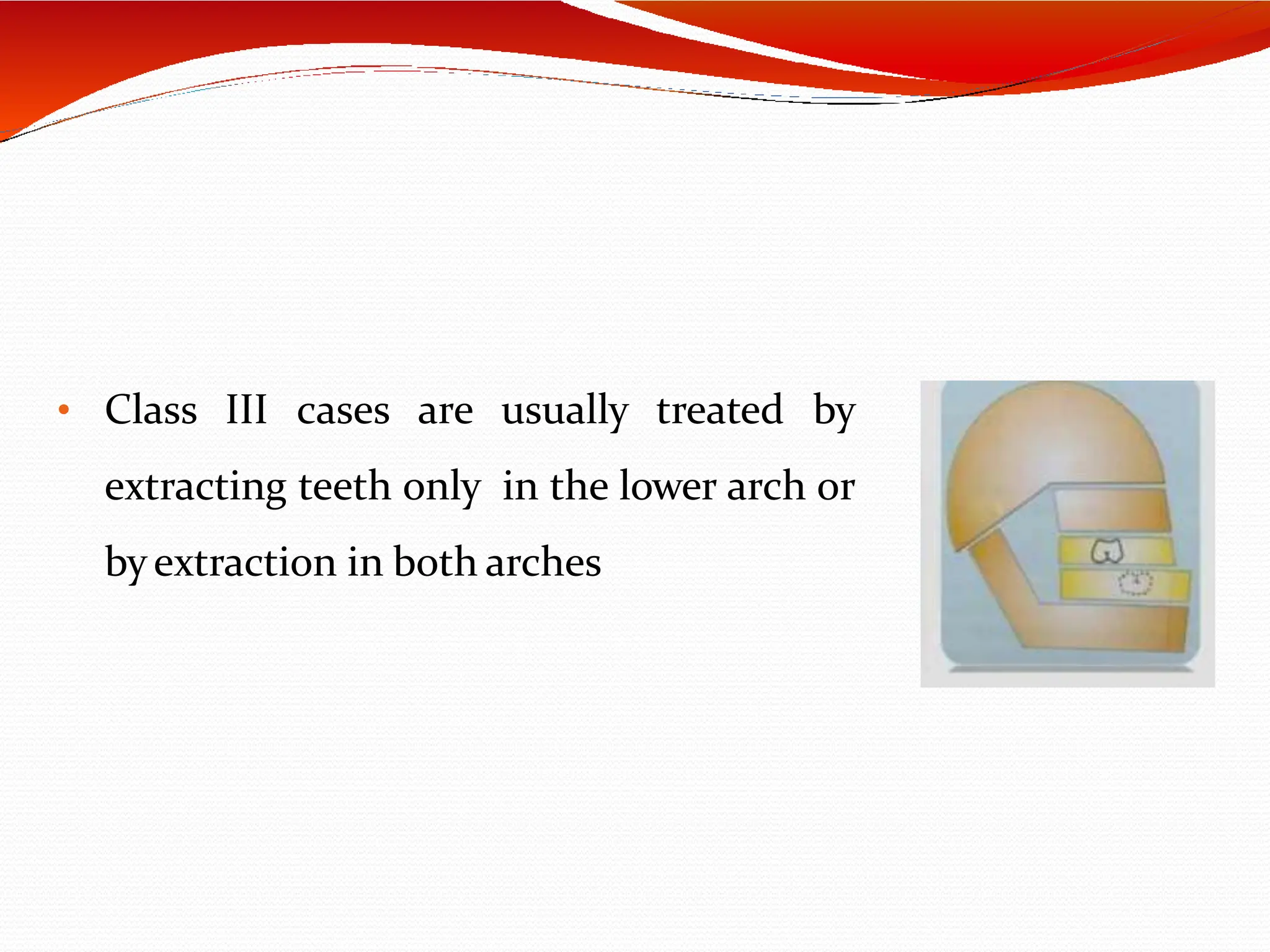 UG CLASS EXTRACTION IN ORTHODONTICS.pptx