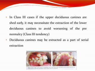 UG CLASS EXTRACTION IN ORTHODONTICS.pptx