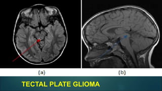 pranay HYDROCEPHALUS.ppt