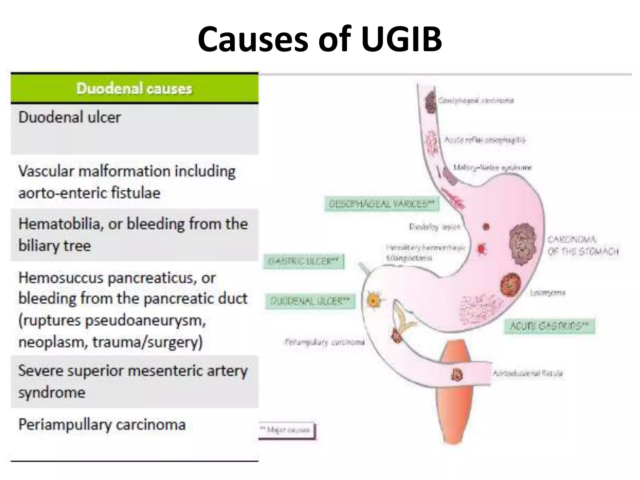 UGIB - ppt 2023.pptx