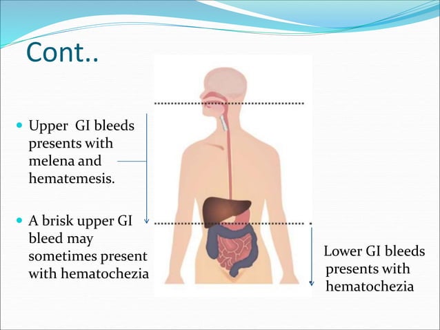 Upper GI Bleeding | PPTX