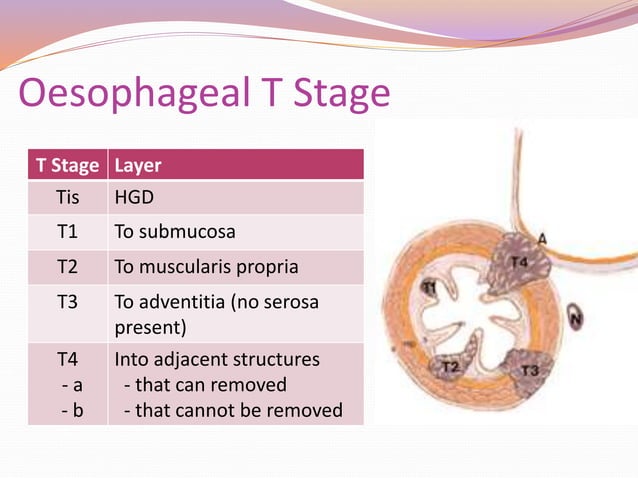 Upper GI Cancer - Nicola Tanner | PPTX | Cancer | Diseases and Conditions