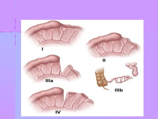 intestinal atresia | PPT