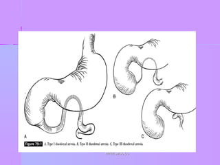 intestinal atresia | PPT