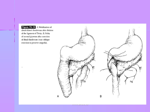 intestinal atresia | PPT | Pregnancy | Reproductive Health
