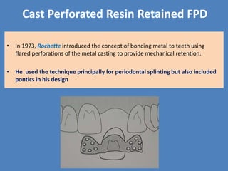 UG lecture Resin Bonded FPD'S.pptx