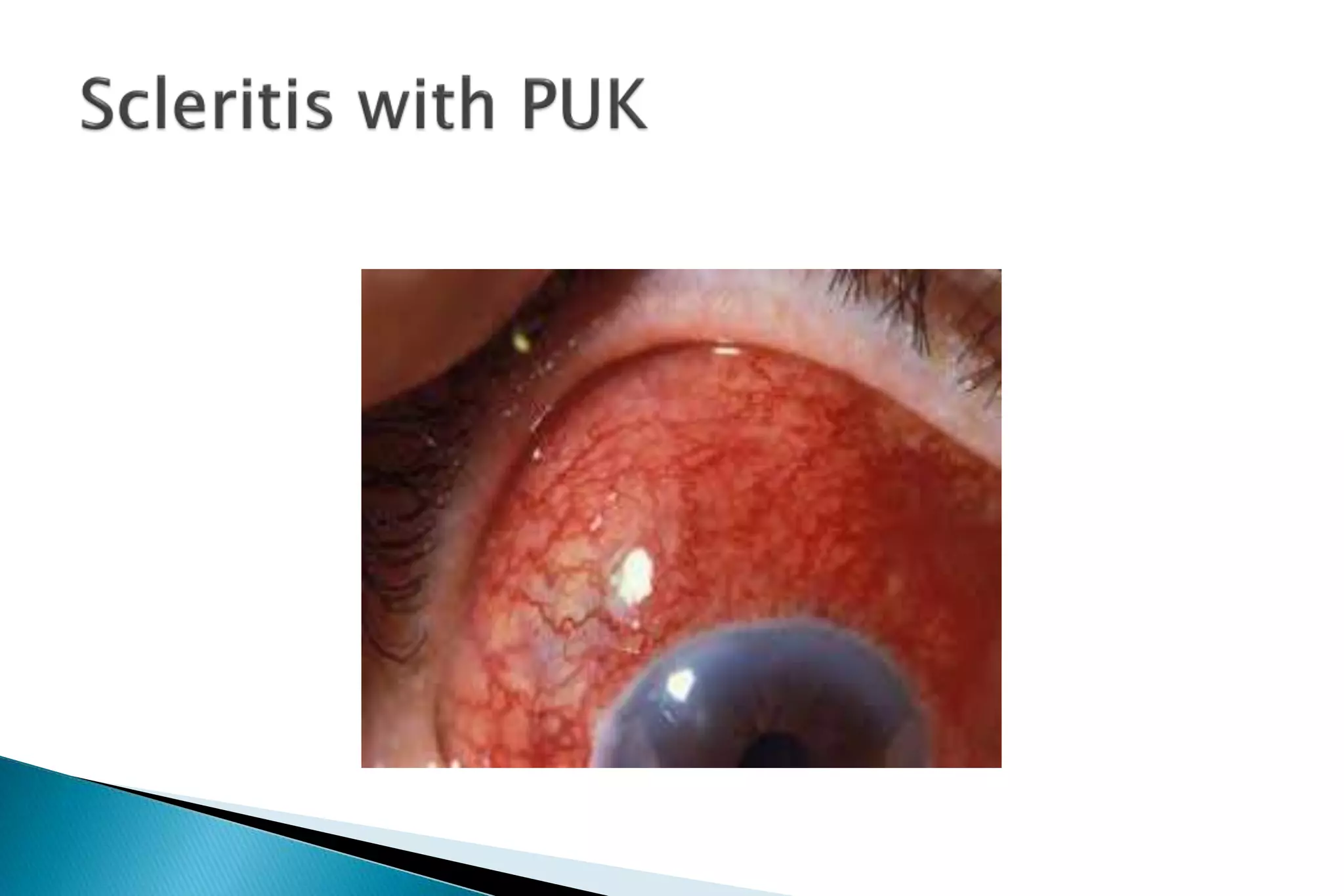 SCLERITIS | PPT