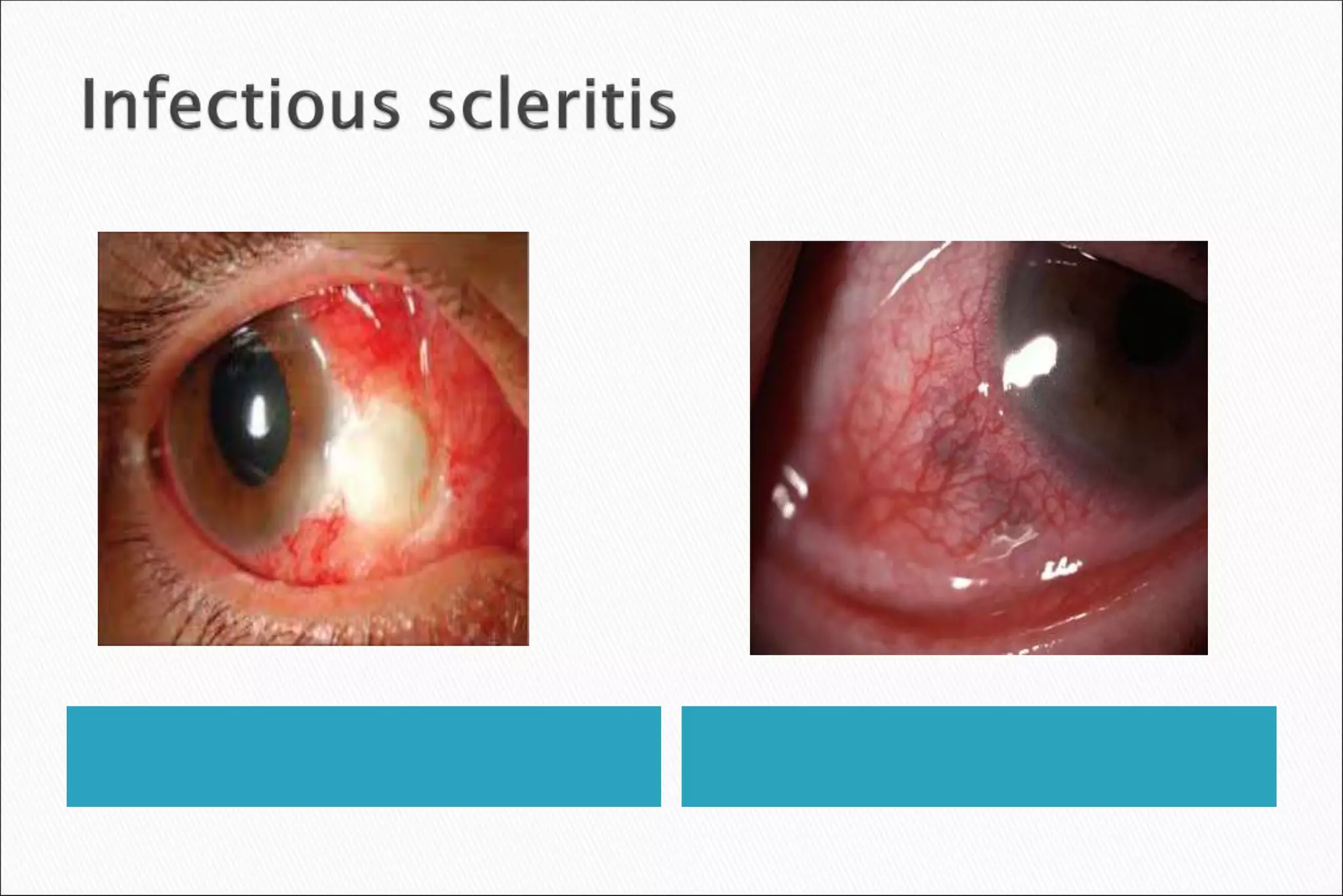 SCLERITIS | PPT
