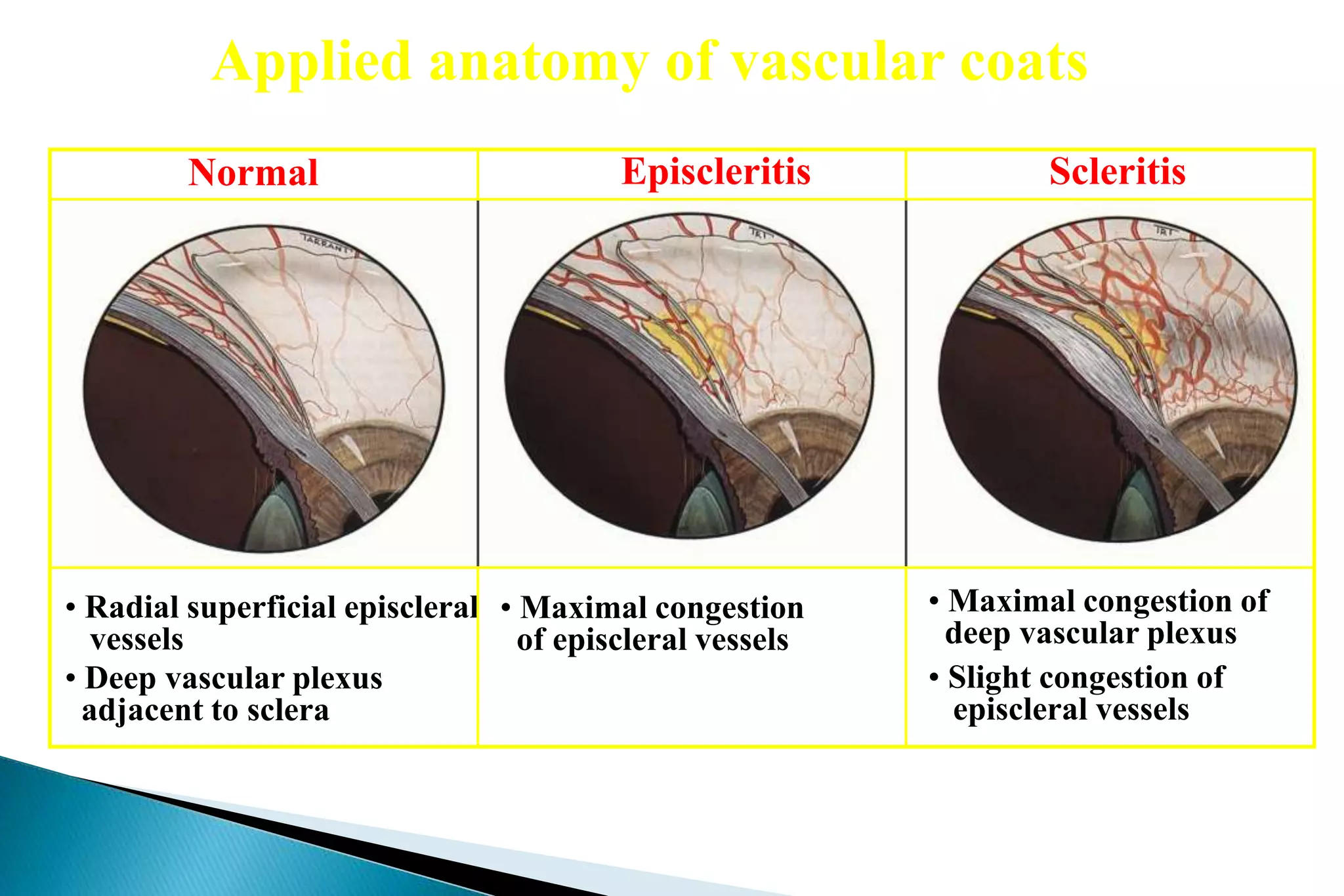 SCLERITIS | PPT
