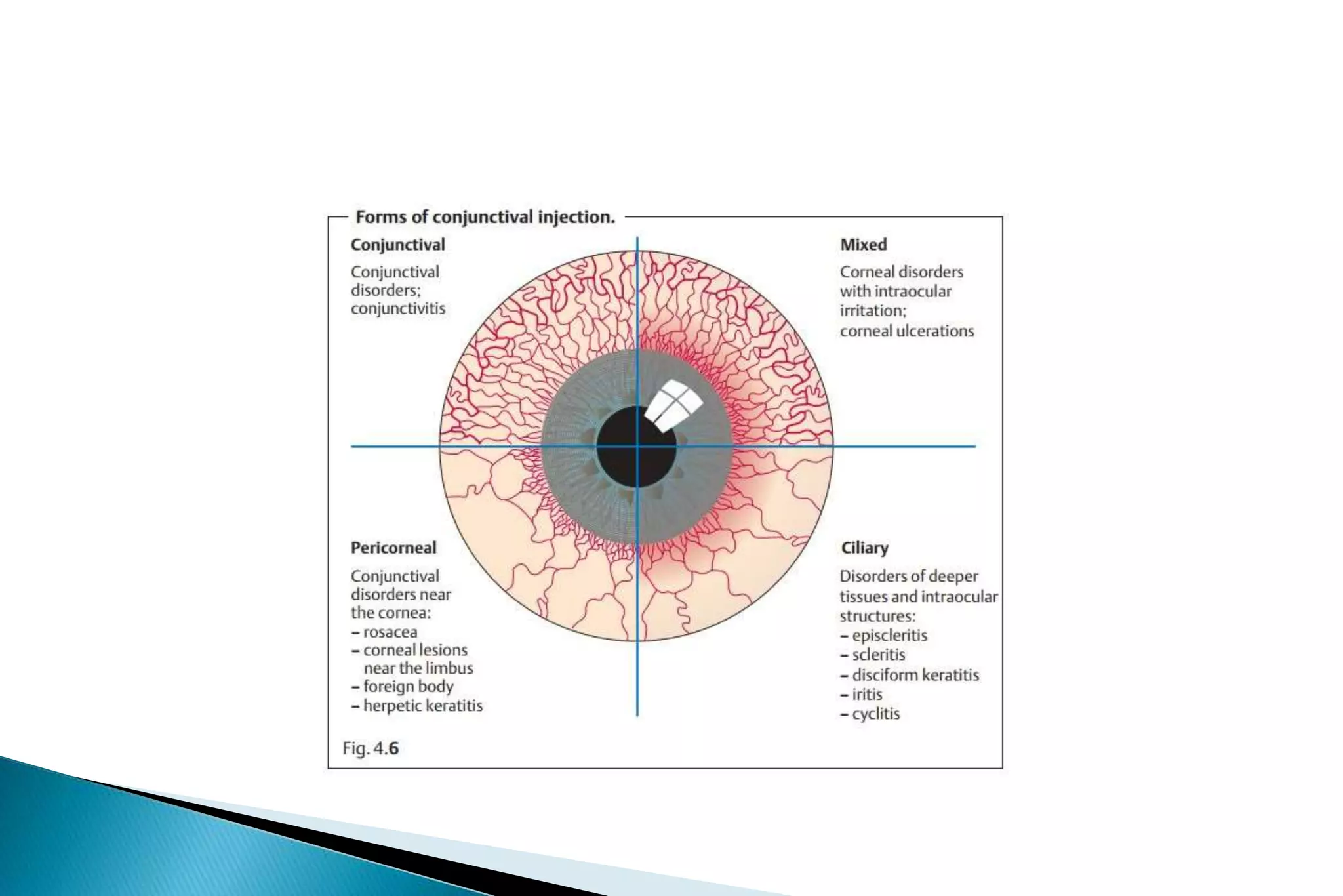 SCLERITIS | PPT